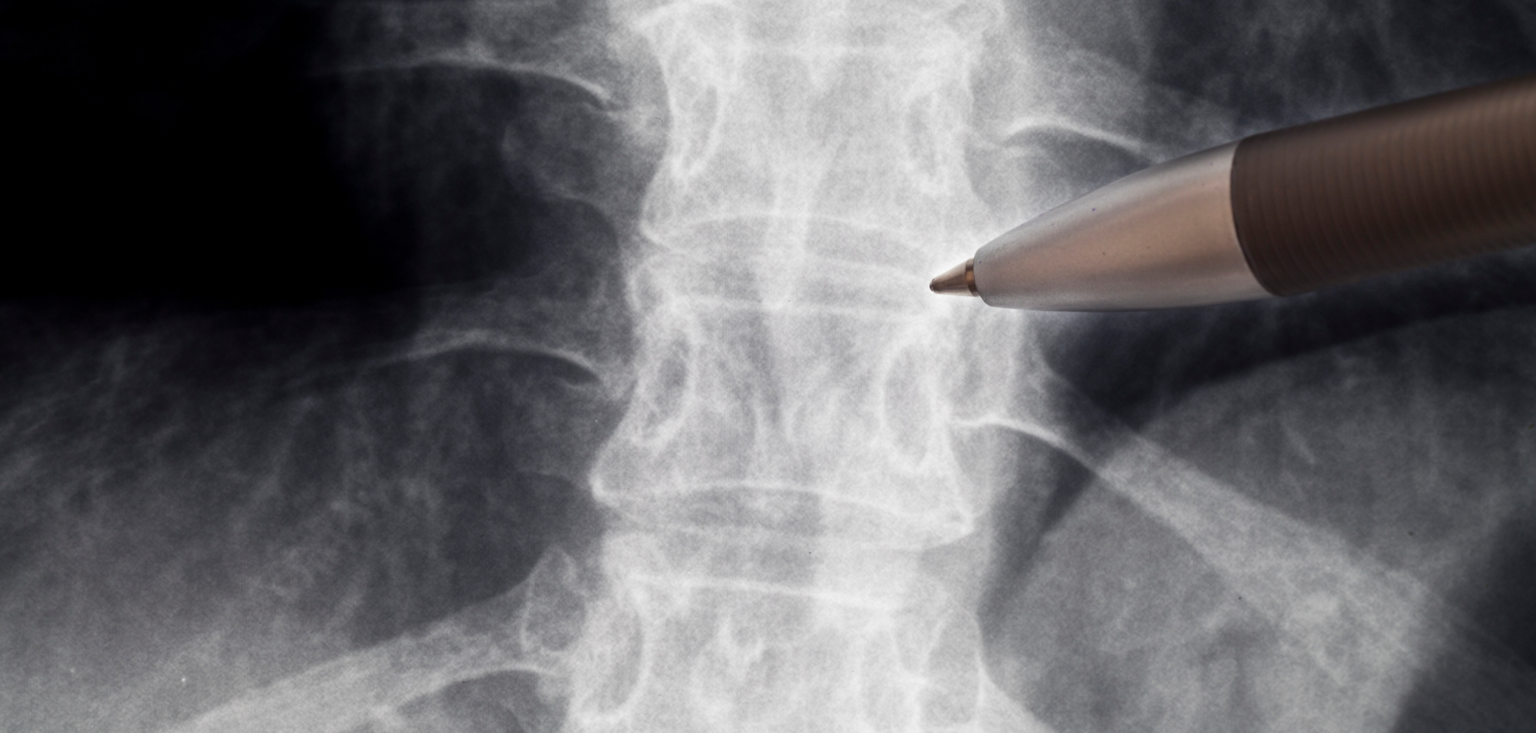 Understanding Unstable Spinal Cord Fractures - Howie Sacks & Henry LLP